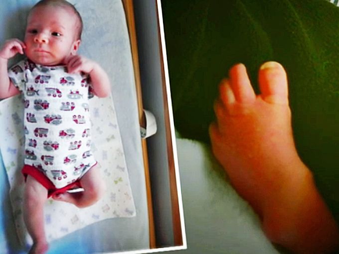 Toddler with only 5 toes learns to walk | wtsp.com