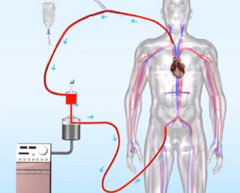 TGH doctors can now vacuum out blood clots | wtsp.com