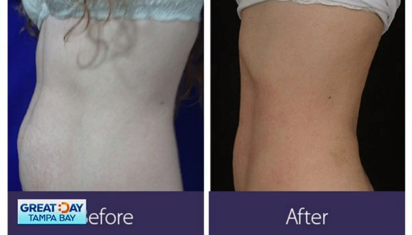 Fat Freezing Technology! | wtsp.com